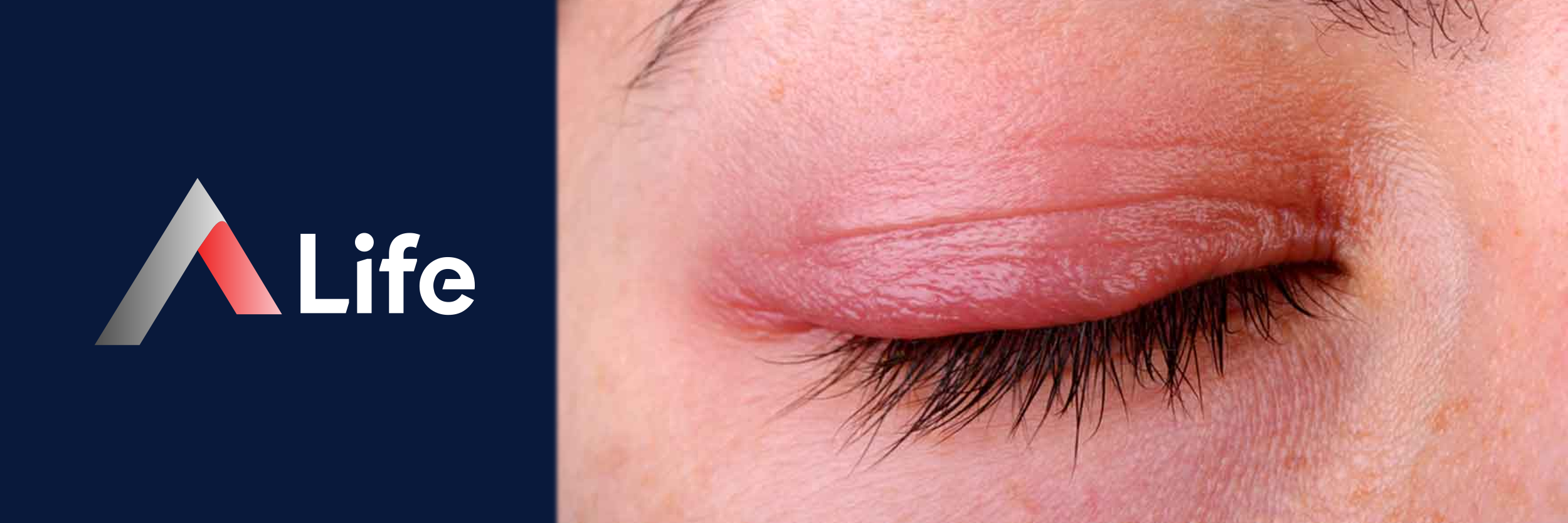 Blefarit Nedenleri ve Tedavi Yöntemleri | A Life Sağlık Grubu