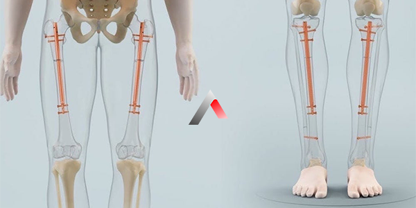 Bone Lengthening Surgery | A Life Health Group