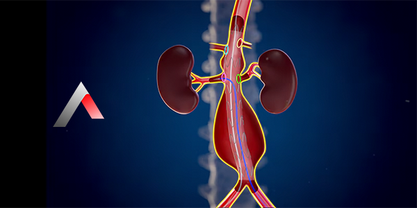 EVAR (Endovasküler Anevrizma Onarımı) | A Life Sağlık Grubu