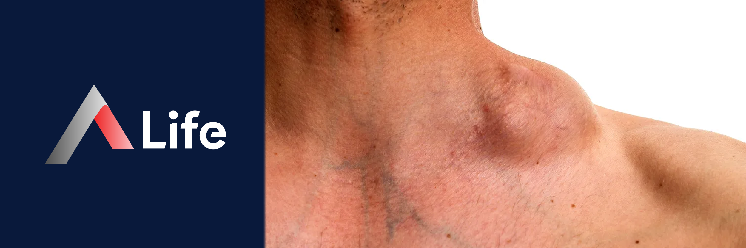 Hodgkin Lenfoma Nedir? | A Life Sağlık Grubu