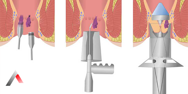 Longo Hemorrhoid Surgery | A Life Health Group