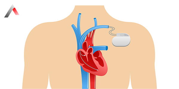 Kalp Pili İşlemleri | A Life Sağlık Grubu