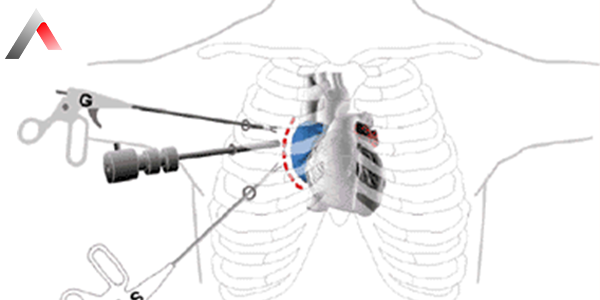 Minimally Invasive Heart Surgery | A Life Health Group