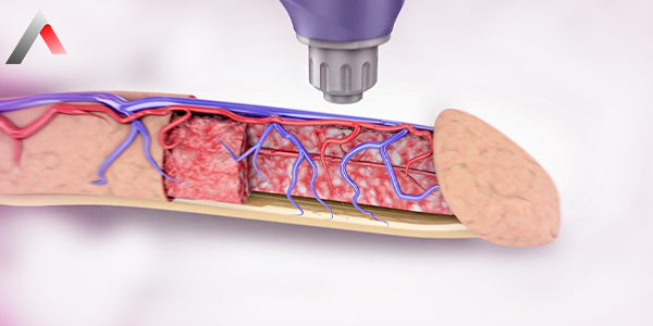 What Is Penoplasty Surgery? | A Life Health Group