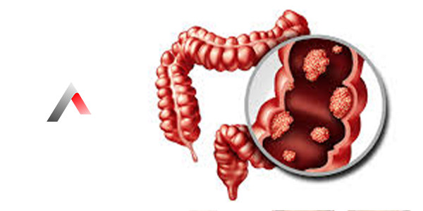 Rektum Kanseri Belirtileri | A Life Sağlık Grubu