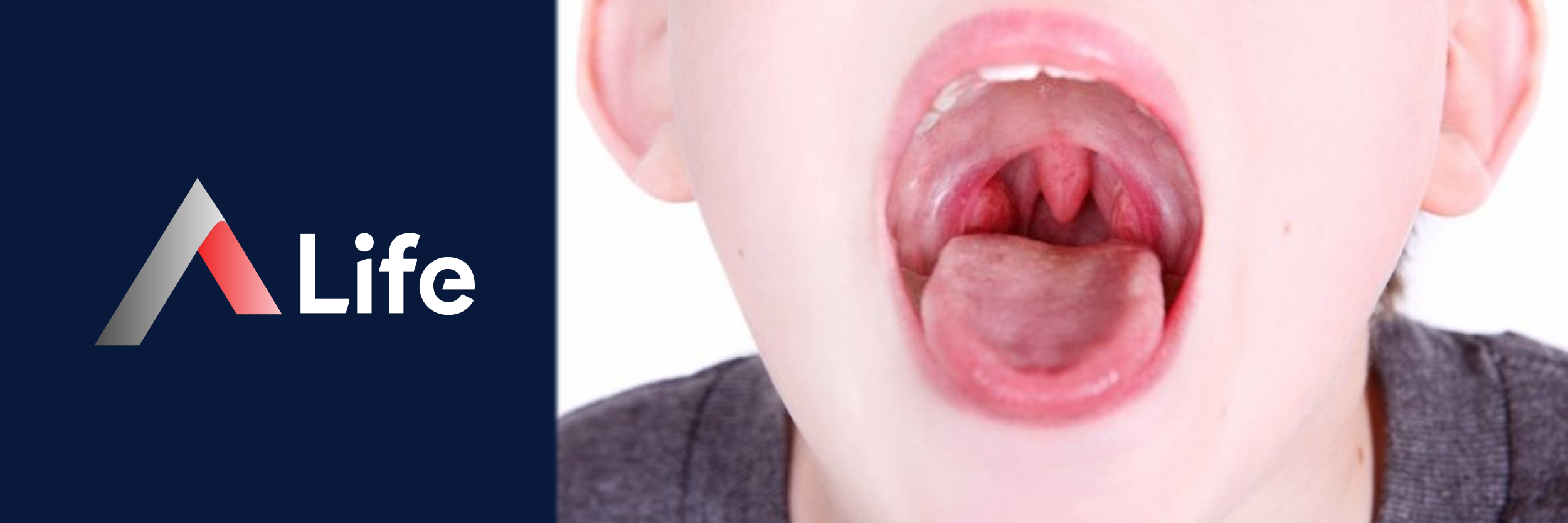 Tonsillit Nedir? Belirtileri ve Tedavisi | A Life Sağlık Grubu