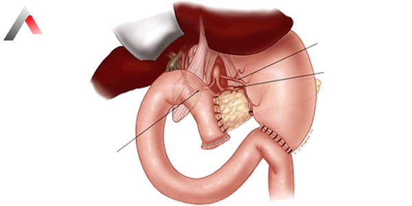 Pancreatitis Surgery | A Life Health Group