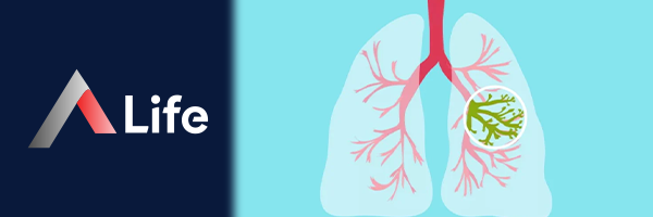 Kistik Fibrozis | A Life Sağlık Grubu