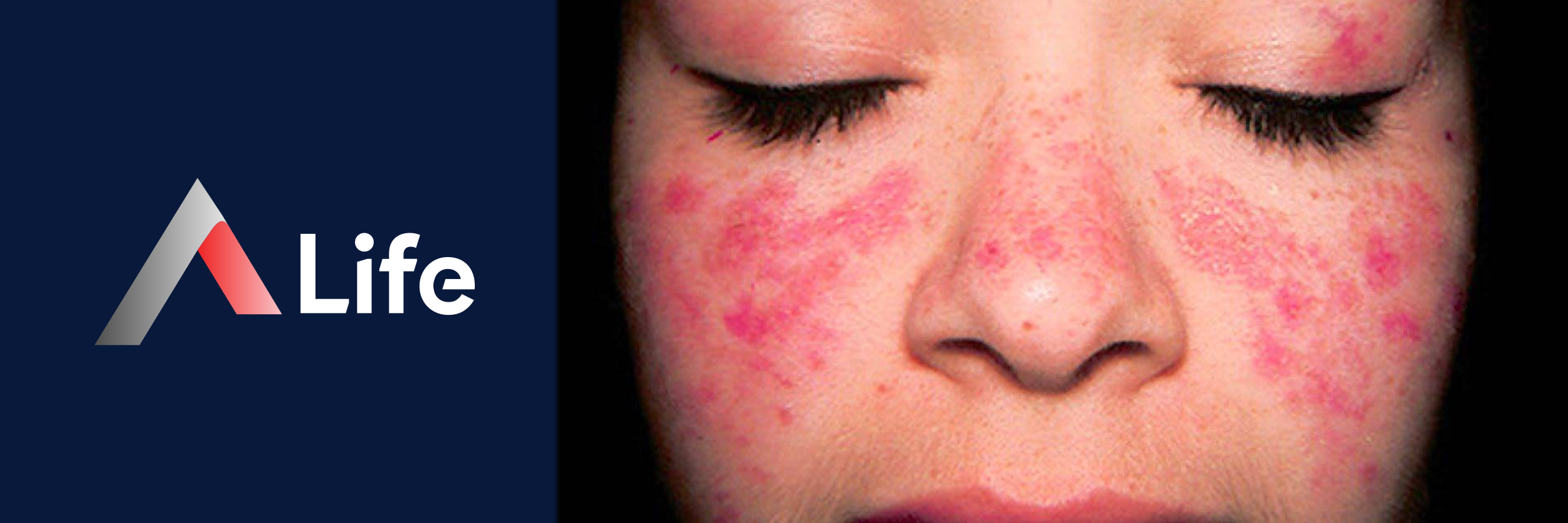 SLE Hastalığı Nedir? | A Life Sağlık Grubu