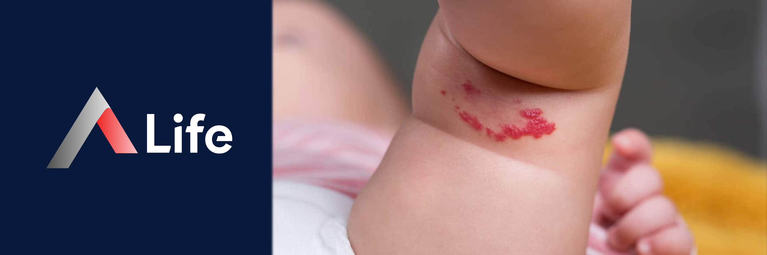 Temre Hastalığı | A Life Sağlık Grubu